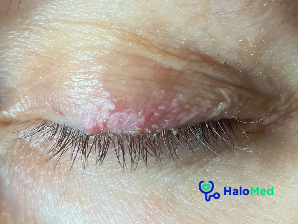 Nużyca. Czym są nużeńce? Objawy oraz przyczyny