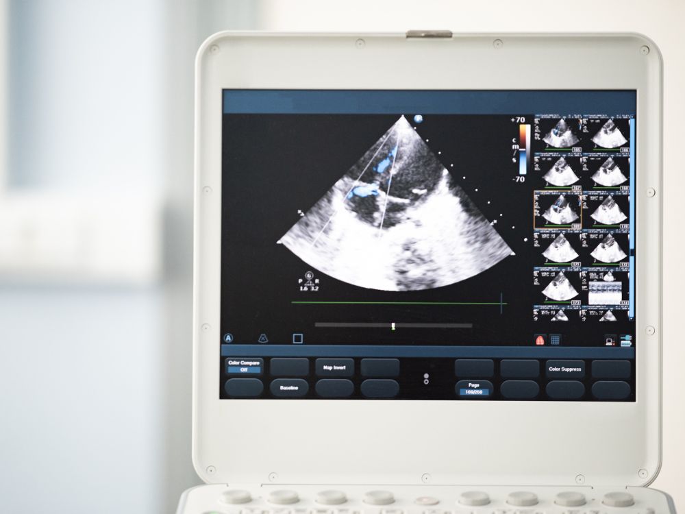 USG Doppler. Badanie Dopplera. Jak przebiega? Jak się przygotować?